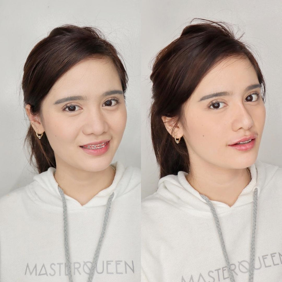 Nose Sculpture – Prettylooks Aesthetic Center