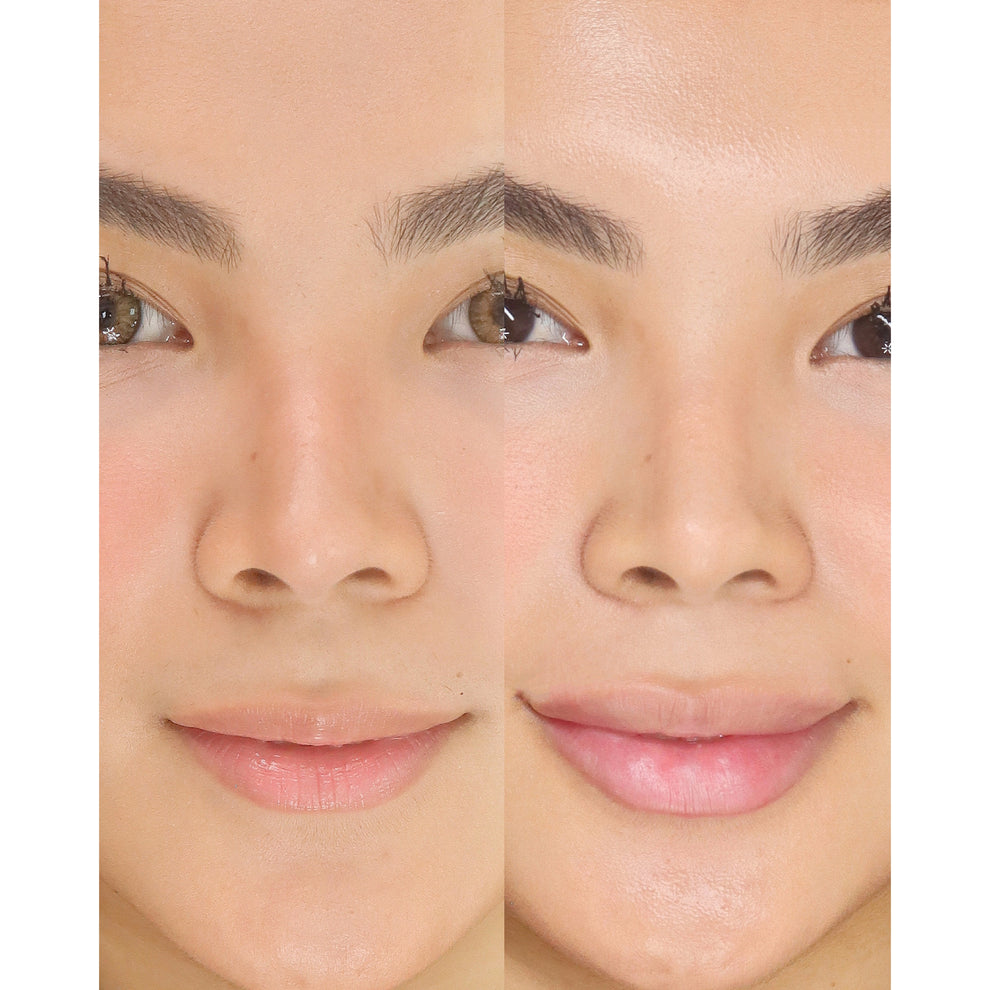 Lip Pout – Prettylooks Aesthetic Center