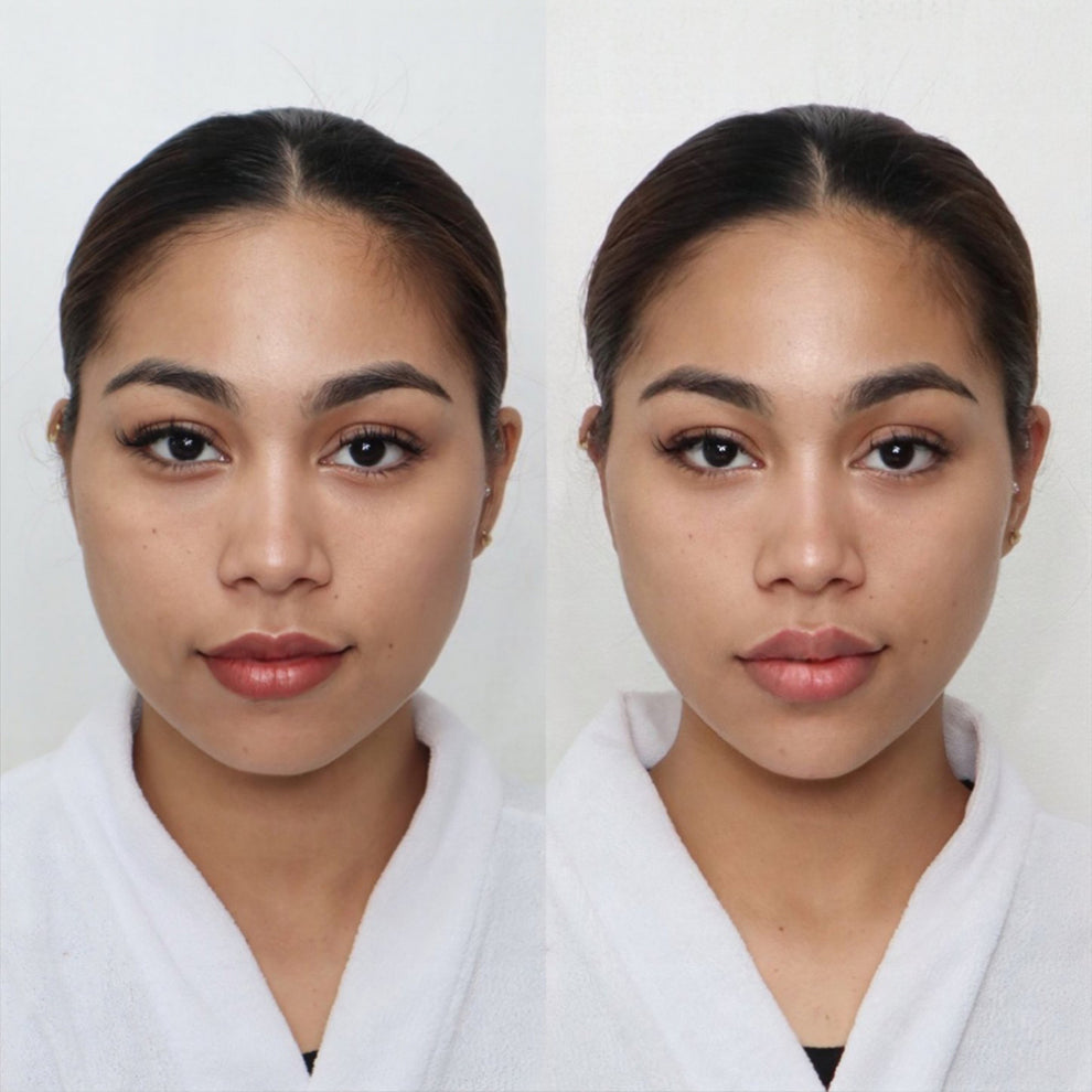 Y Contour – Prettylooks Aesthetic Center